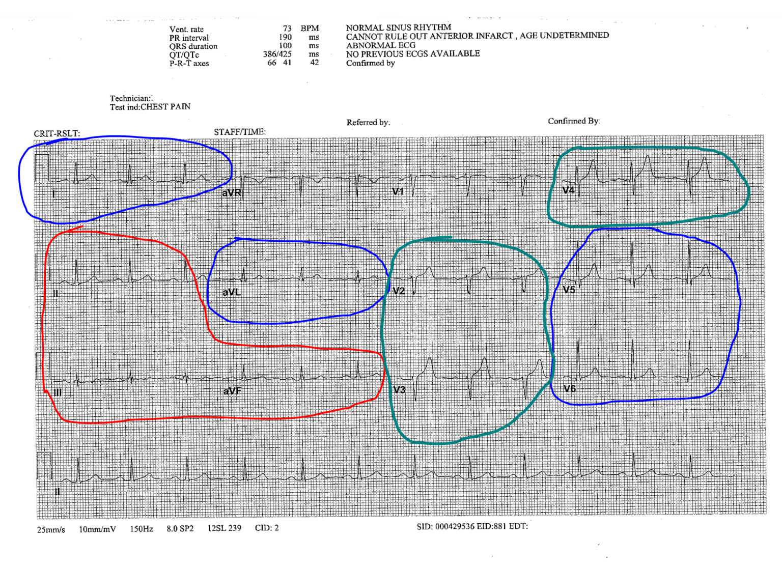How Much to Know About the 12-Lead ECG - Nursing Priorities