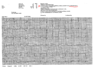 How Much to Know About the 12-Lead ECG - Nursing Priorities