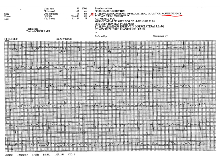 How Much to Know About the 12-Lead ECG - Nursing Priorities