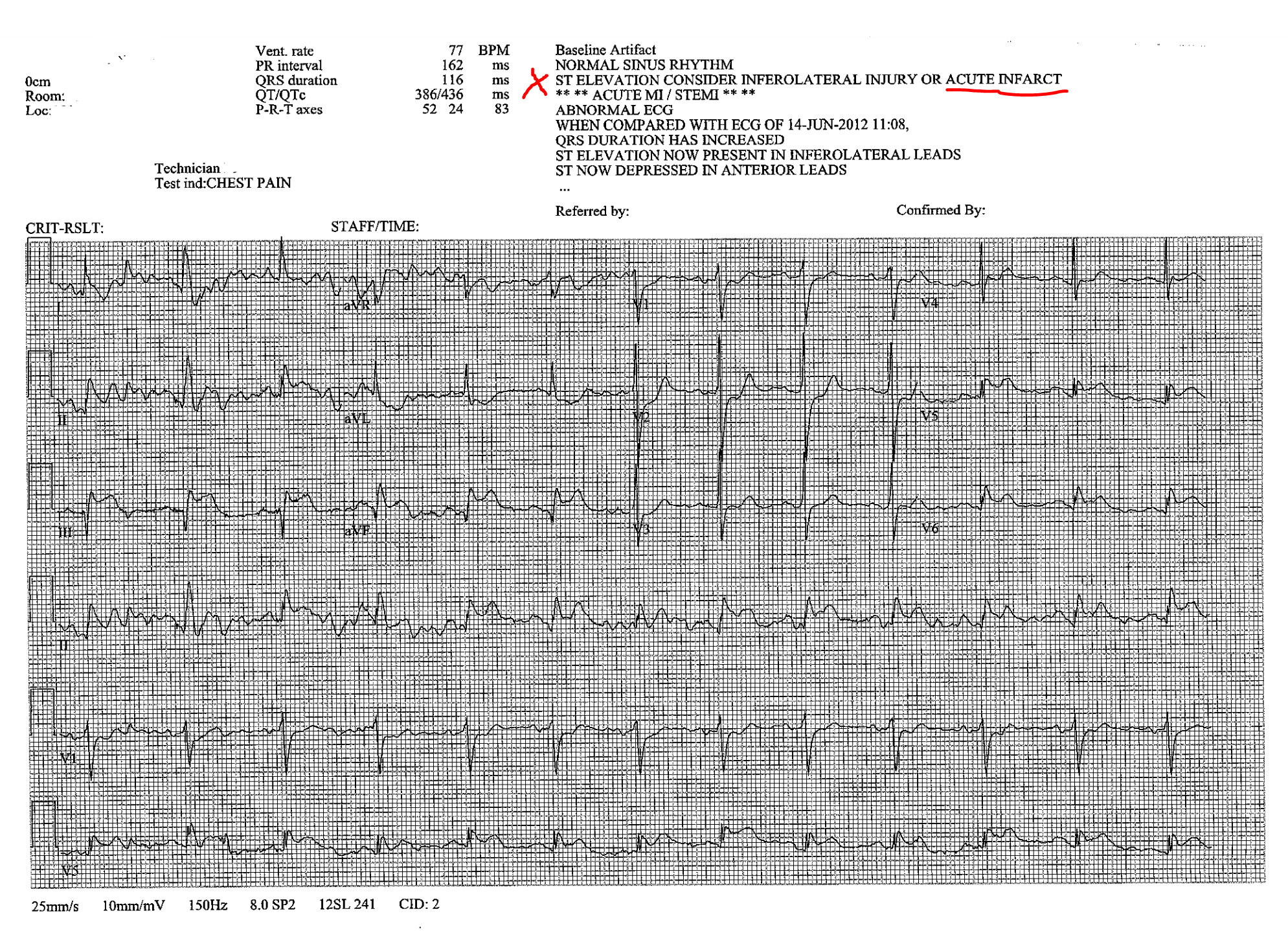 How Much to Know About the 12-Lead ECG - Nursing Priorities